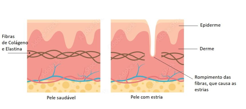 “Microderme” o método revolucionário de combate às estrias